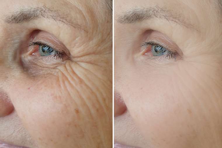 Cosmetic Aesthetic Treatments - Sunshine Coast